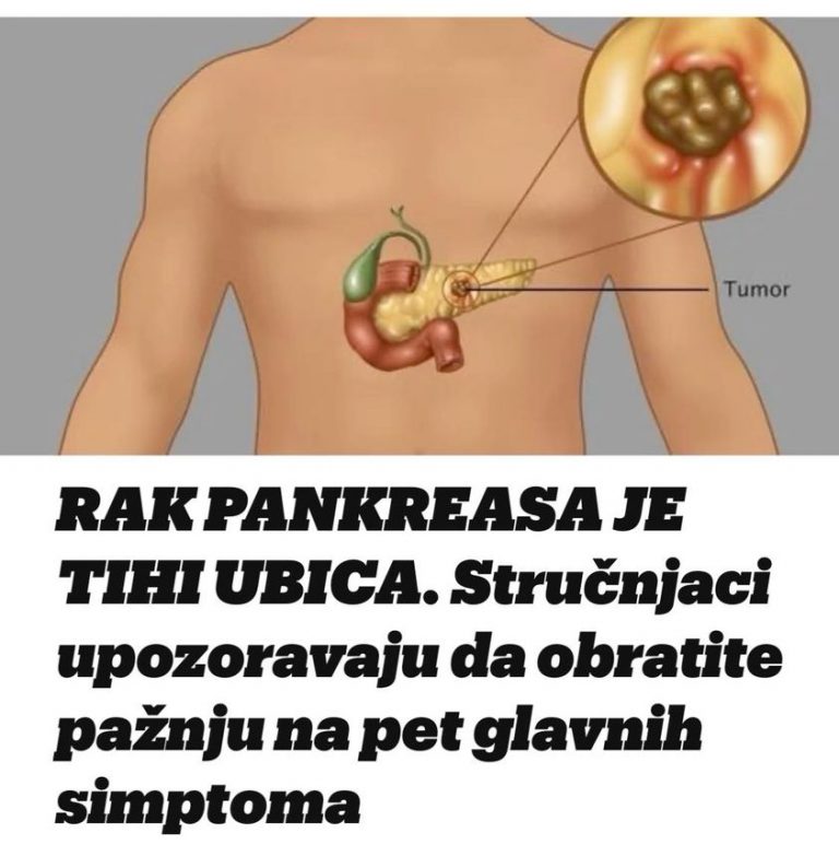 RAK PANKREASA JE TIHI UBICA. Stručnjaci upozoravaju da obratite pažnju na pet glavnih simptoma ...